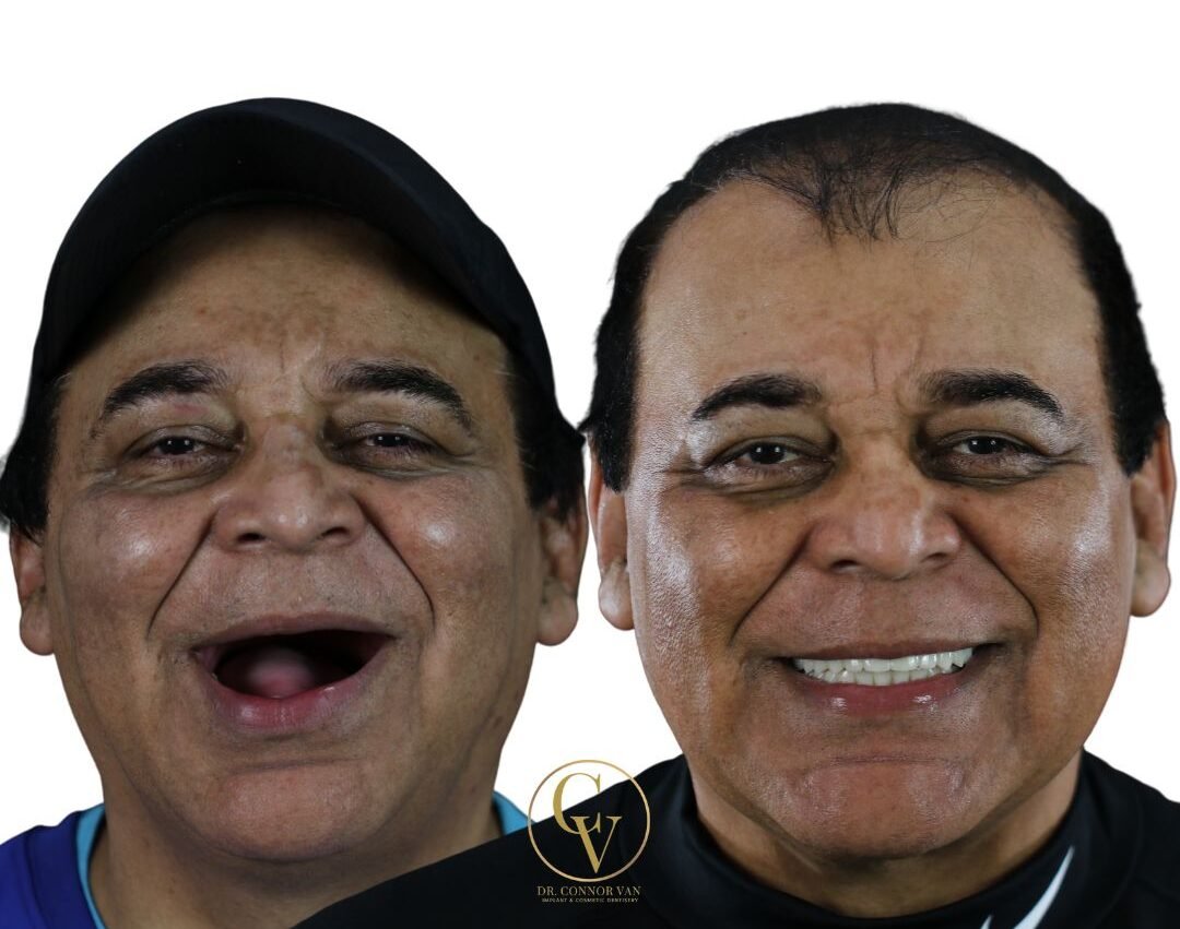 New Teeth Florida Dental Implants – Dr. Connor Van - New Teeth Orlando ...